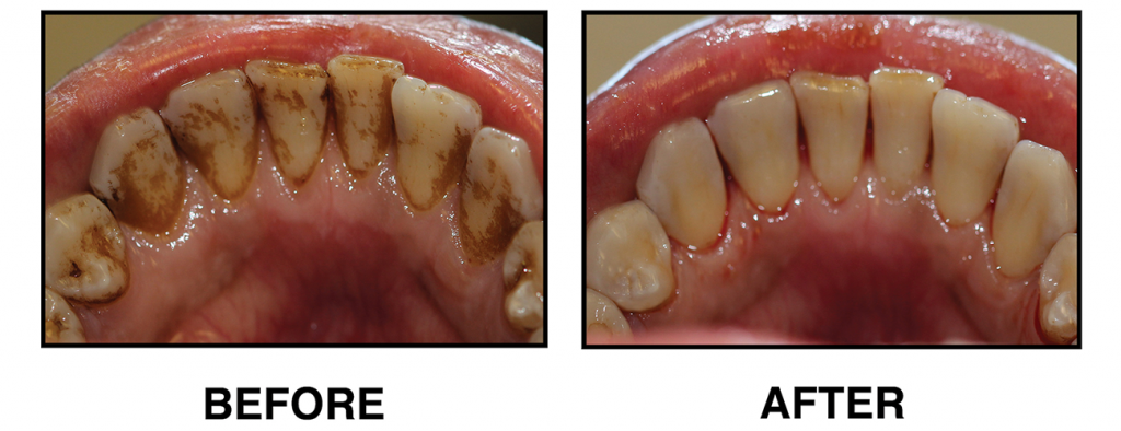 Stain Removal - Good Dentist